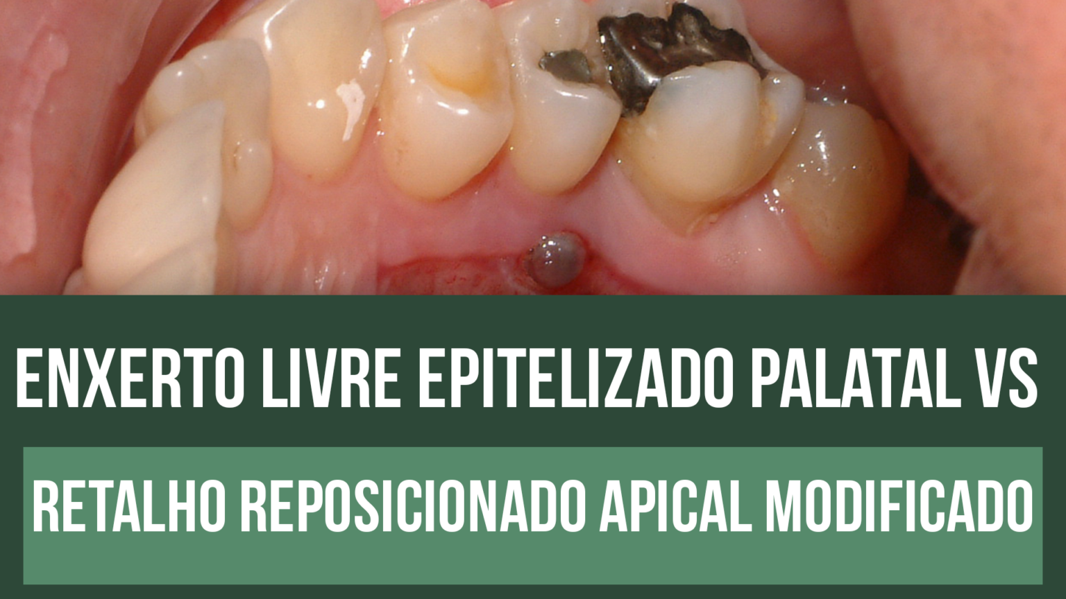 Arquivos Retalho reposicionado apical modificado - Mentor Odonto